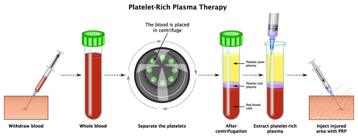 Platelet-rich plasma (PRP) therapy – HICC International